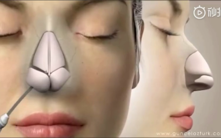 一个可以清晰的了解隆鼻手术的全过程视频。