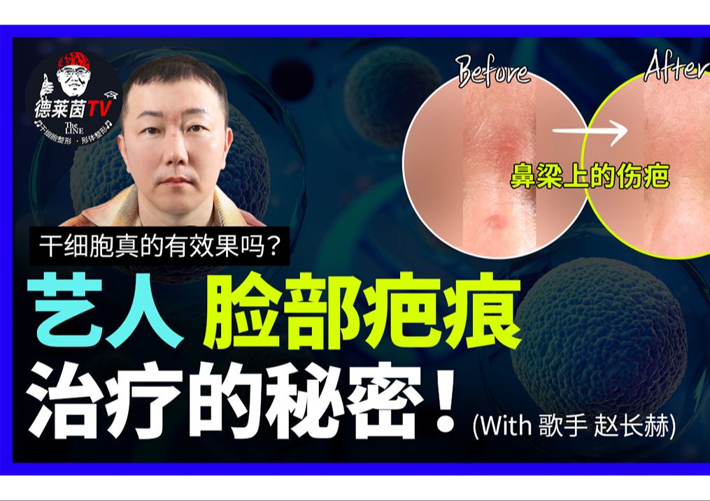 【韩国德莱茵】干细胞治疗疤痕真的可以吗?韩国明星脸上疤痕治疗法...
