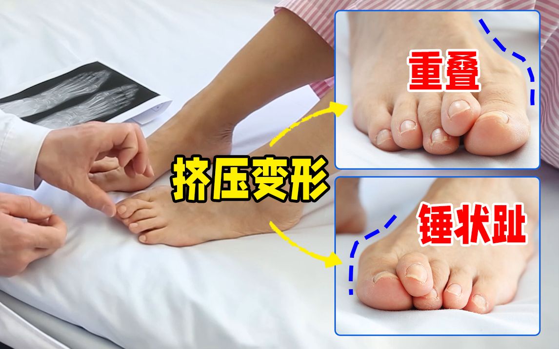 【苏敬达】大脚骨可以不治疗?骨突、拇指外翻、脚趾挤压变形,要注意...