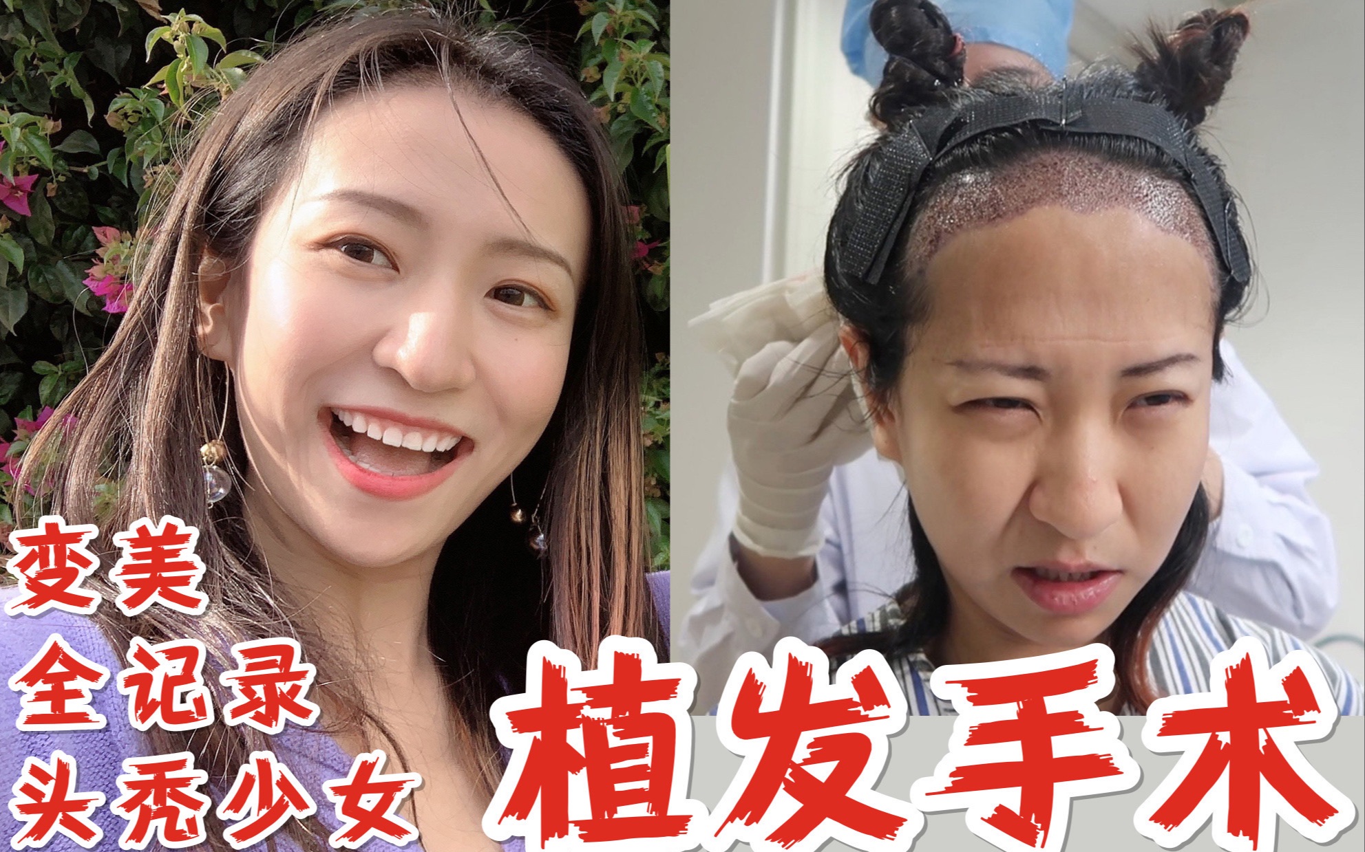 为了美!头秃UP植发全记录!几万元的植发手术到底值不值?!恢复期什么...