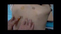 皮下留置针疗法辩证取穴治疗带状疱疹神经痛
