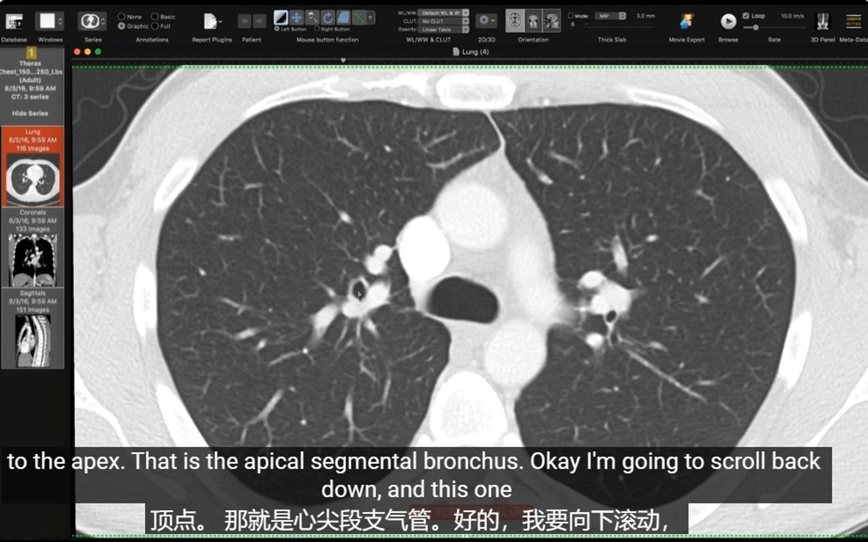如何精确识别肺段与对应支气管?