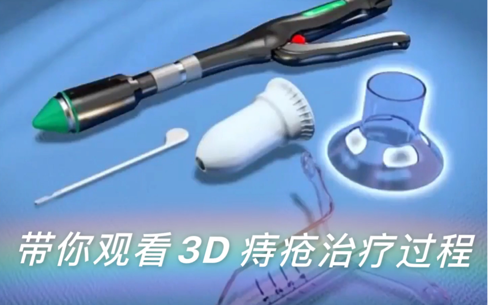 涨知识不迷路!带你观看3D版 痔疮治疗过程