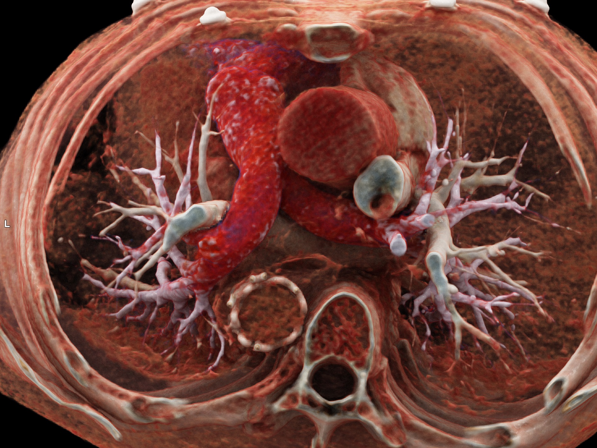 肋骨三维重建操作方法