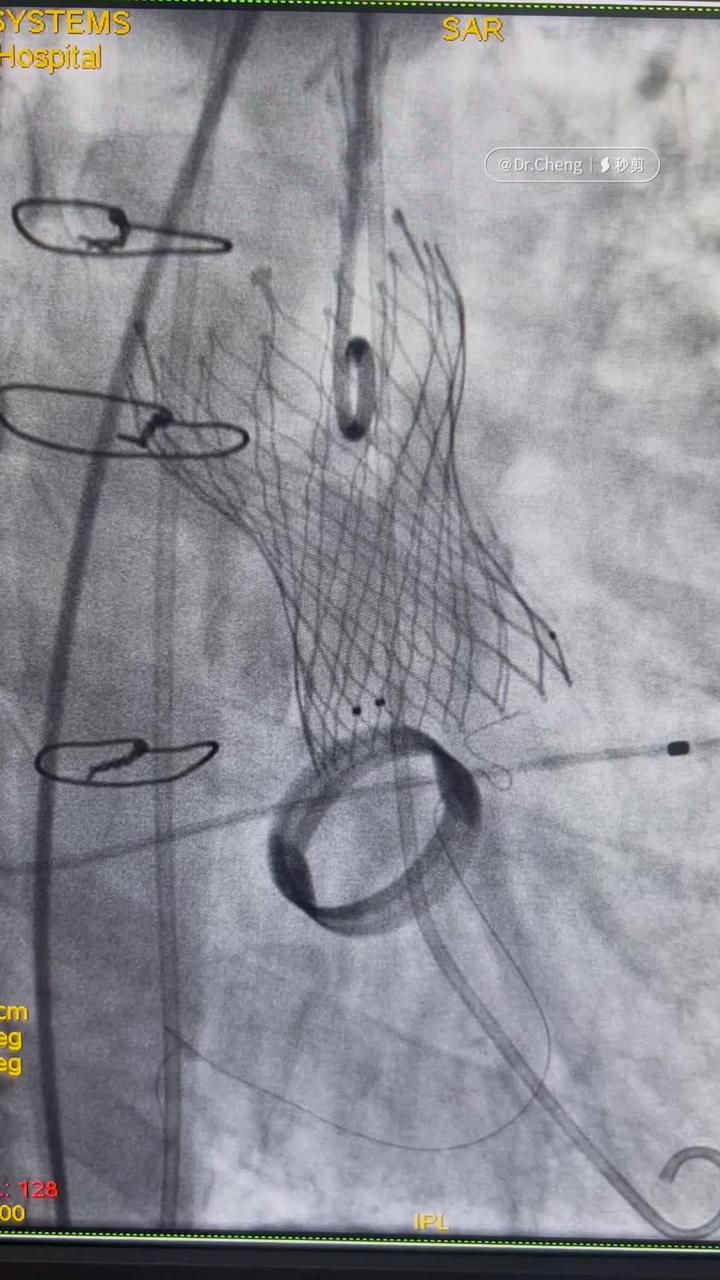 #介入手术 二尖瓣置换术后。现在主动脉瓣狭窄,关闭不全。心功能差,ef...