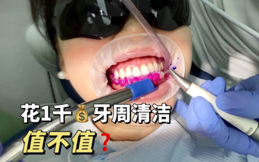 牙周炎《关于29岁在深圳花5000办一张看牙会员卡》被割韭菜了?膜龈...