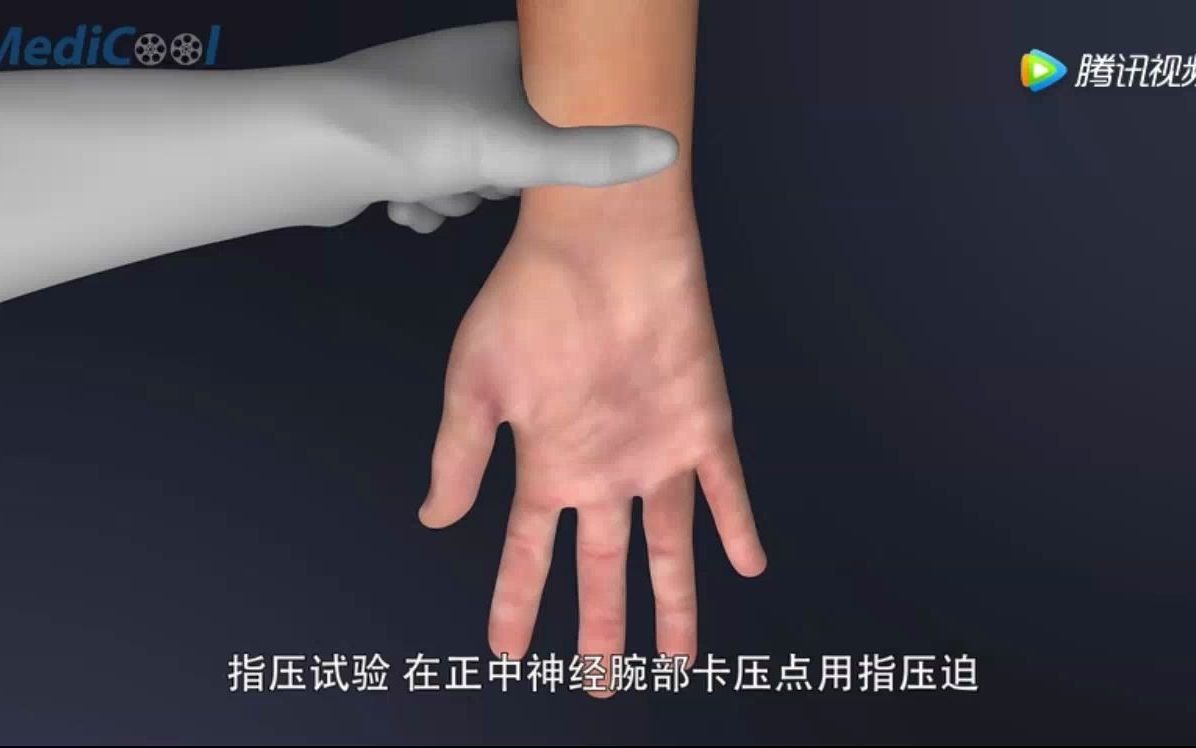 腕管综合征切开减压