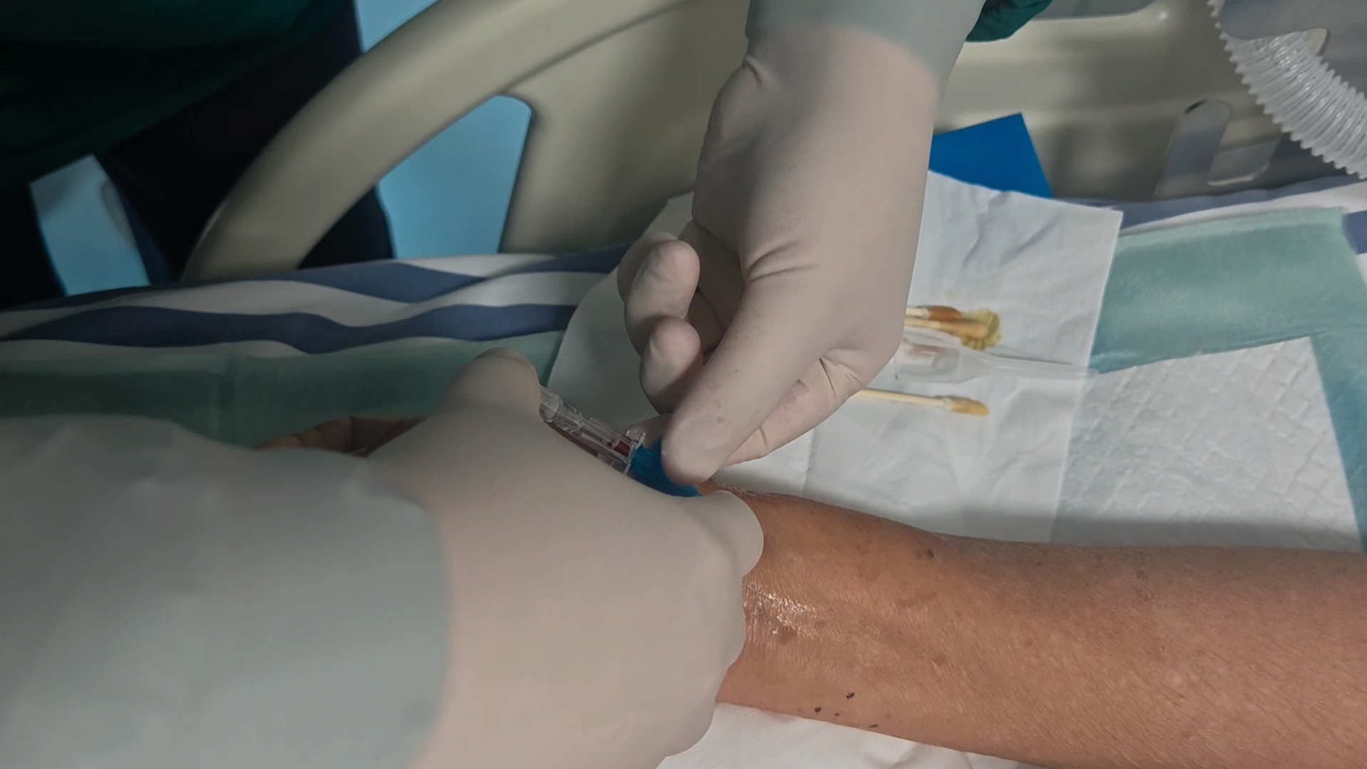 桡动脉穿刺置管,每次做都感觉笨手笨脚的,比起护士老师和麻醉老师还...