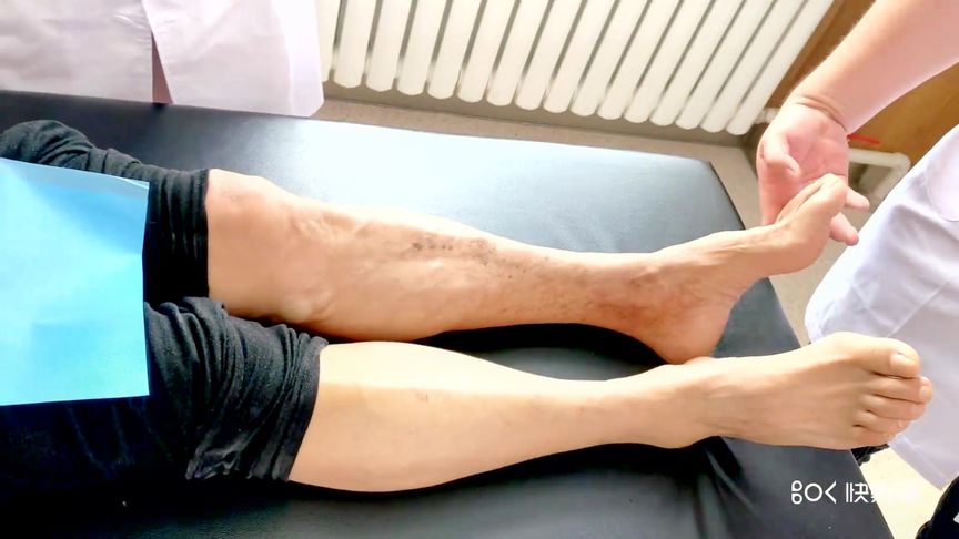 糖尿病下肢血管病变-动脉硬化股动脉注射治疗