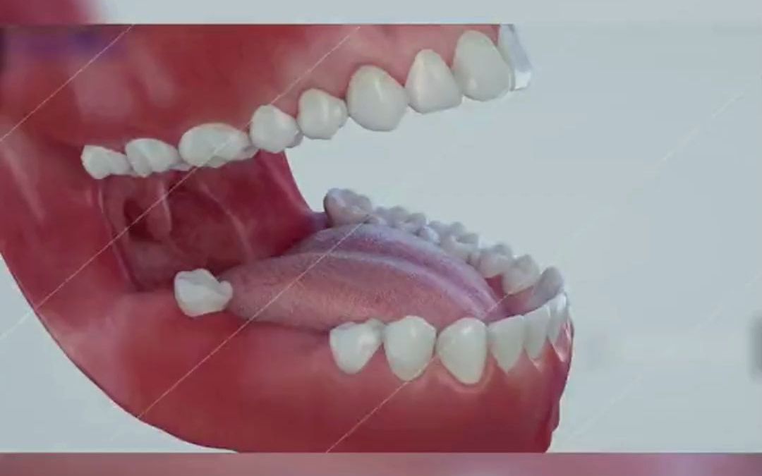 3D动画演示种植牙