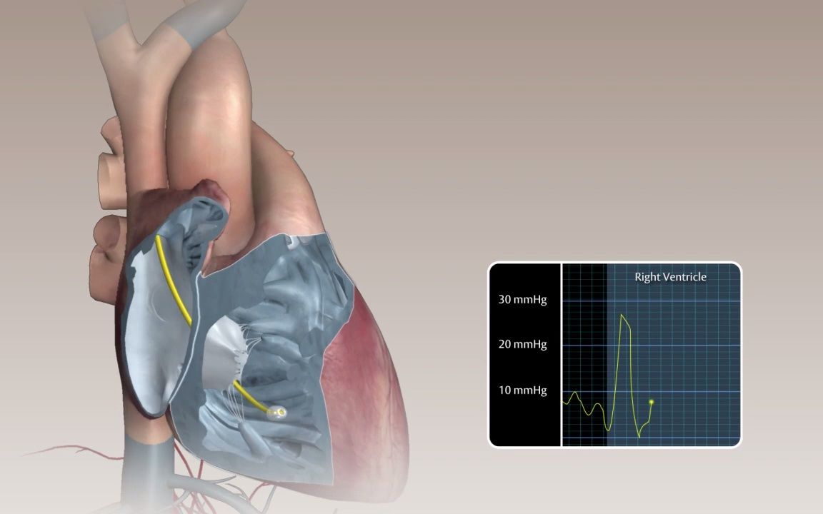 医学动画:Swan Ganz导管放置