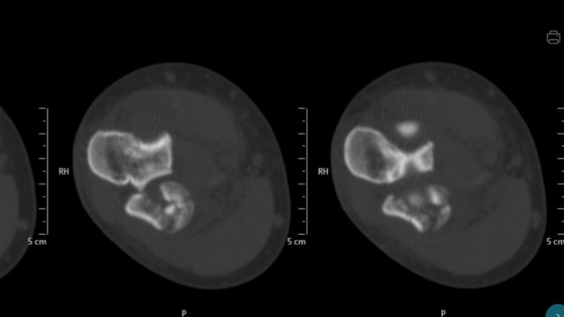 手术教学视频:桡骨头骨折切复内固定术