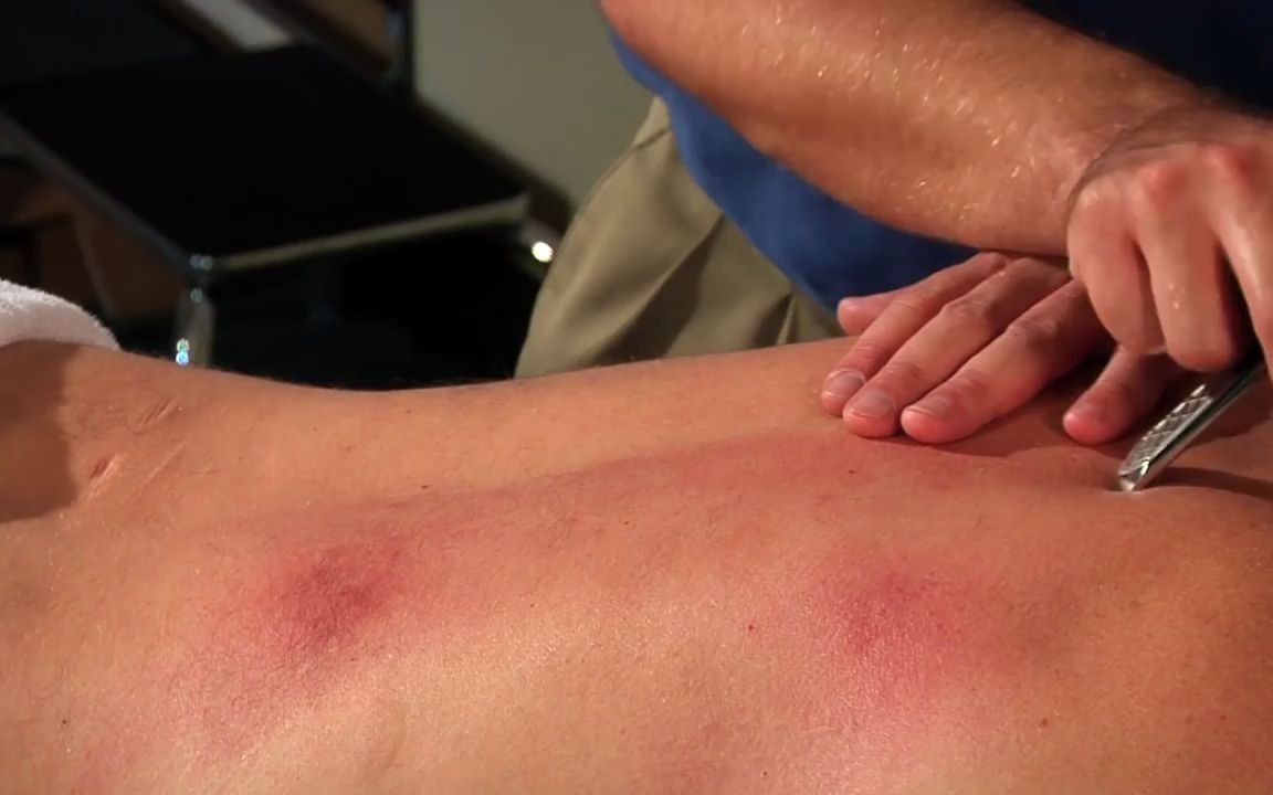 筋膜刀治疗背部疼痛