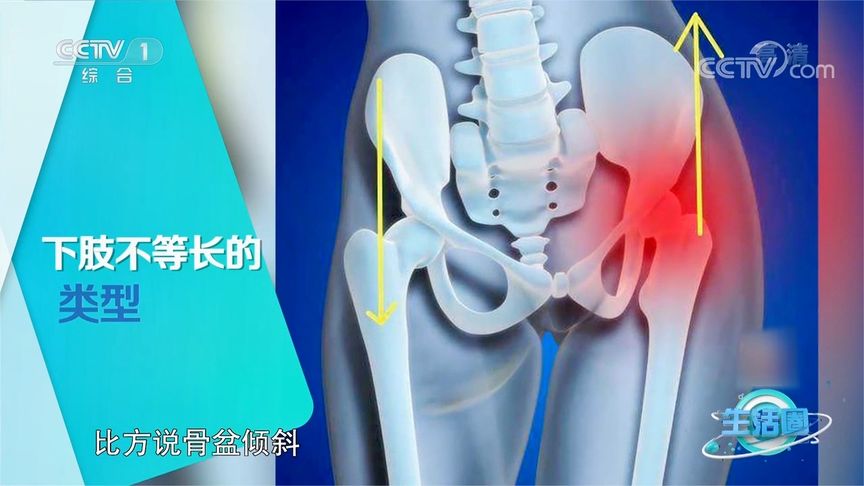 “长短腿”是啥原因造成的,不治疗会有哪些危害?看视频|生活圈