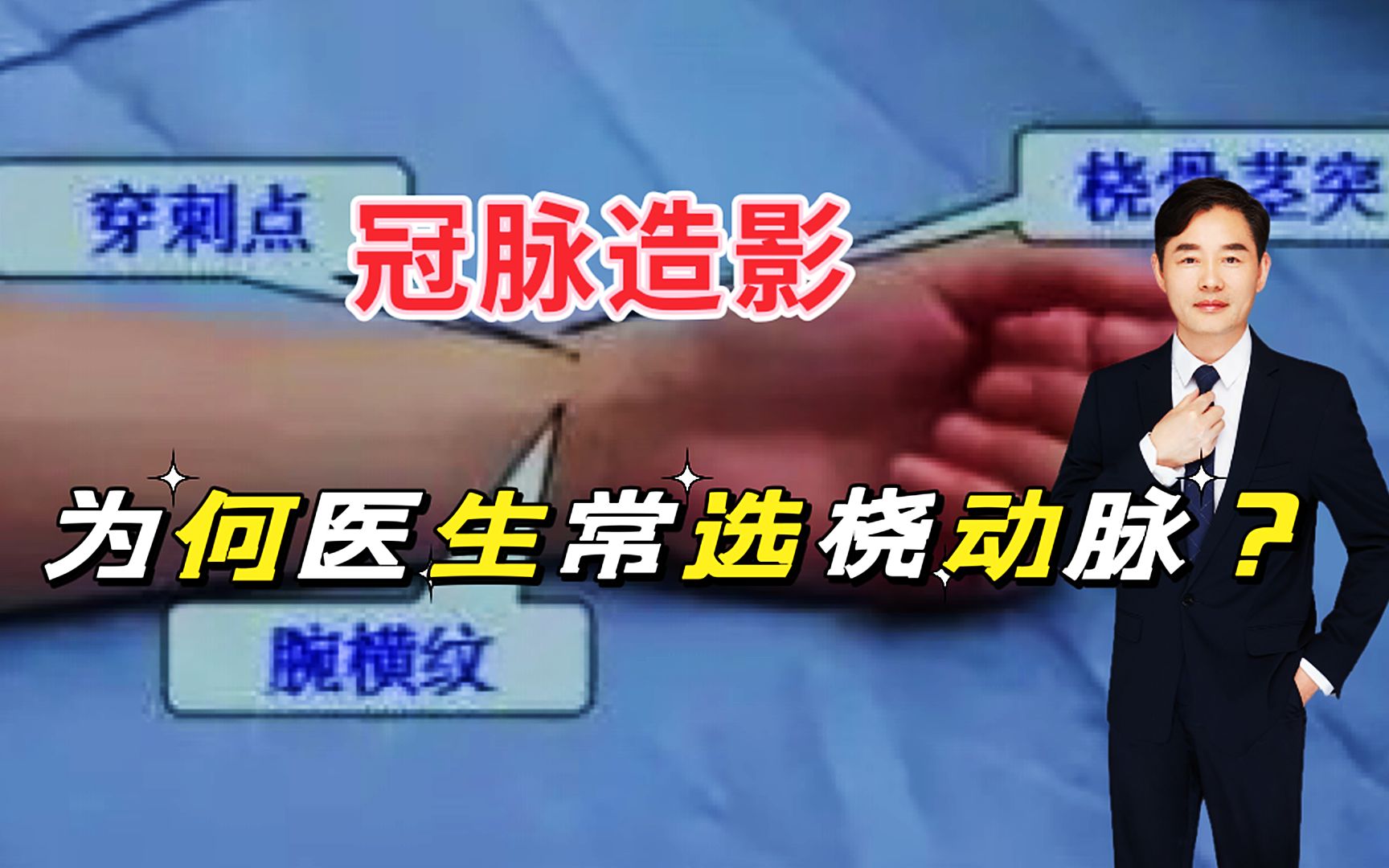 怀疑冠心病,为什么医生喜欢用桡动脉穿刺点做造影?医生告诉你
