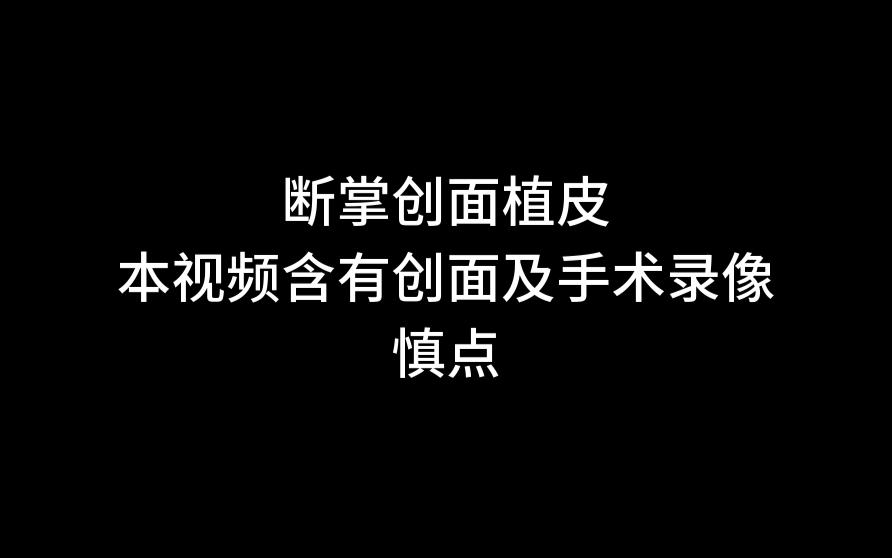 取皮植皮术:断掌创面植皮