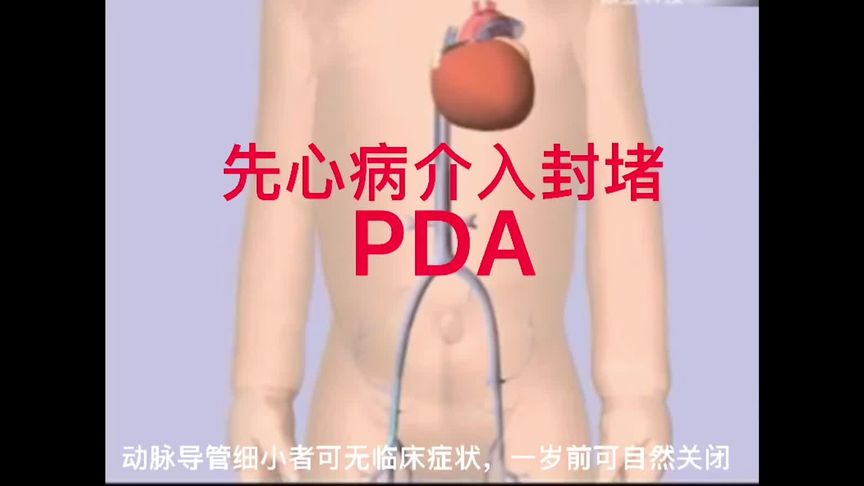 先心病介入治疗-PDA#医学科普