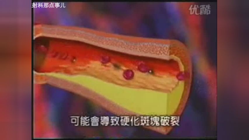 医学科普动画,详细讲解了冠状动脉粥样硬化的发展进程