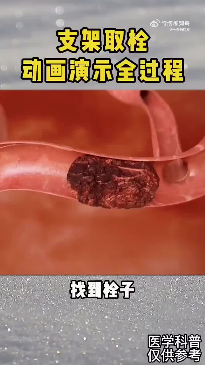 血管支架取栓的动画演示过程