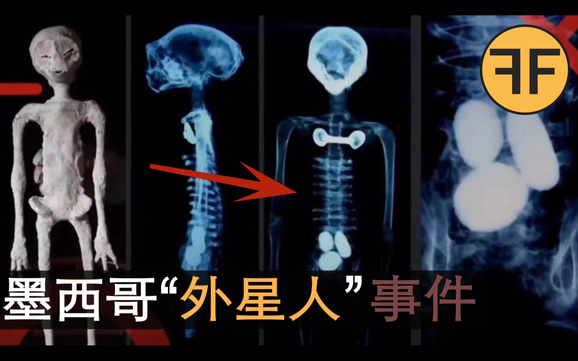 2023年墨西哥国会“外星人”事件“,一个1800年前的医疗事故