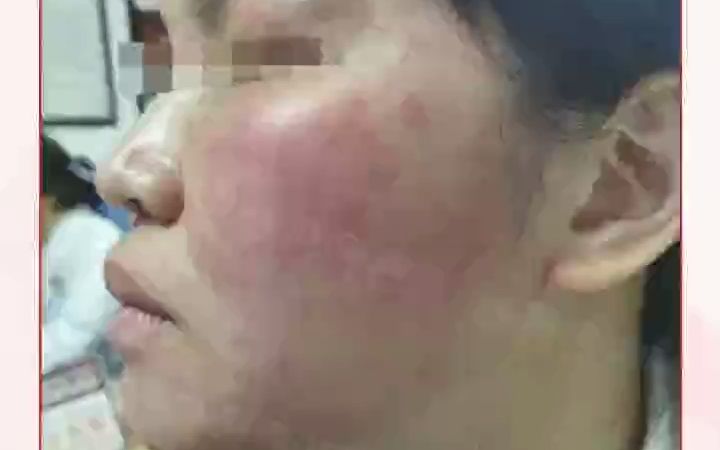 南宁肤康专业医院-痘印痘坑如何修复-脸上痘印去哪个医院可以治疗-...