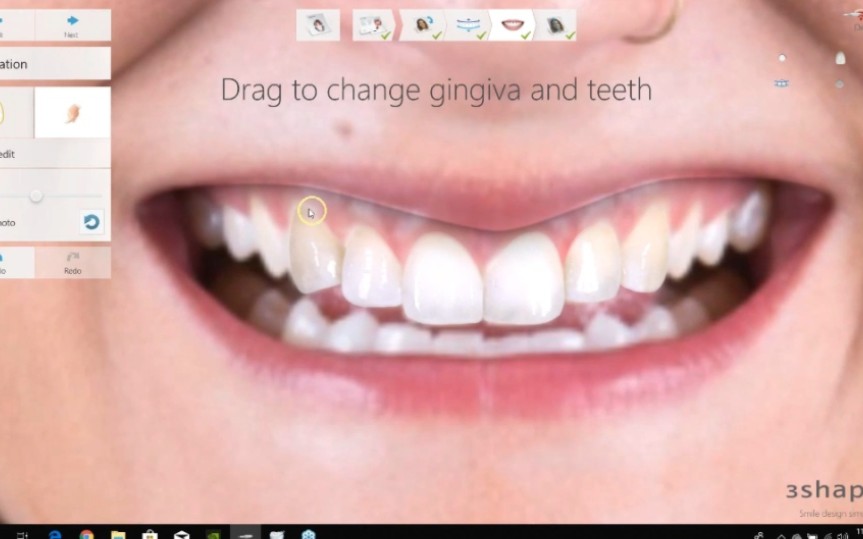 3shape前牙美学设计DSD教程