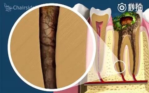 蛀牙破坏牙齿的全过程,根本停不下来,非专业的你值得关注与收藏