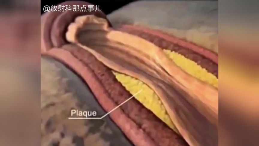 医学3D动画演示:什么是动脉粥样硬化?