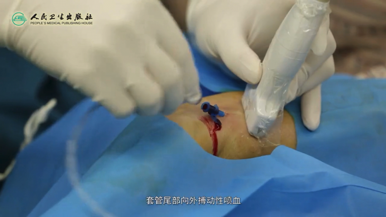 桡动脉穿刺置管术