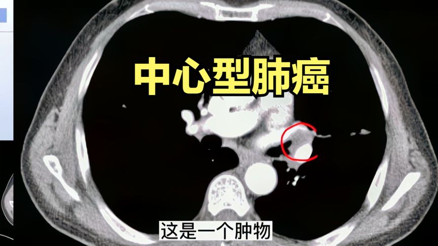 中心型肺癌可以手术吗?CT片怎么看?医生细说