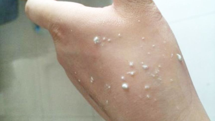 去除死皮原来这么简单,这3种东西加起来,轻松去除死皮没烦恼