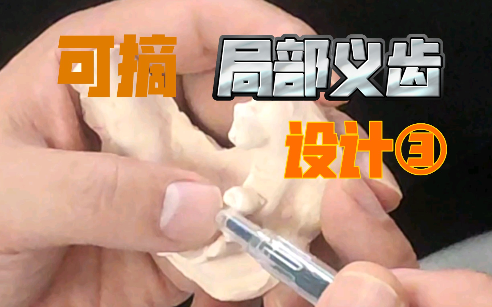 【口修】可摘局部义齿设计-经验分享-倒凹、杆式(下沉问题)、模型...