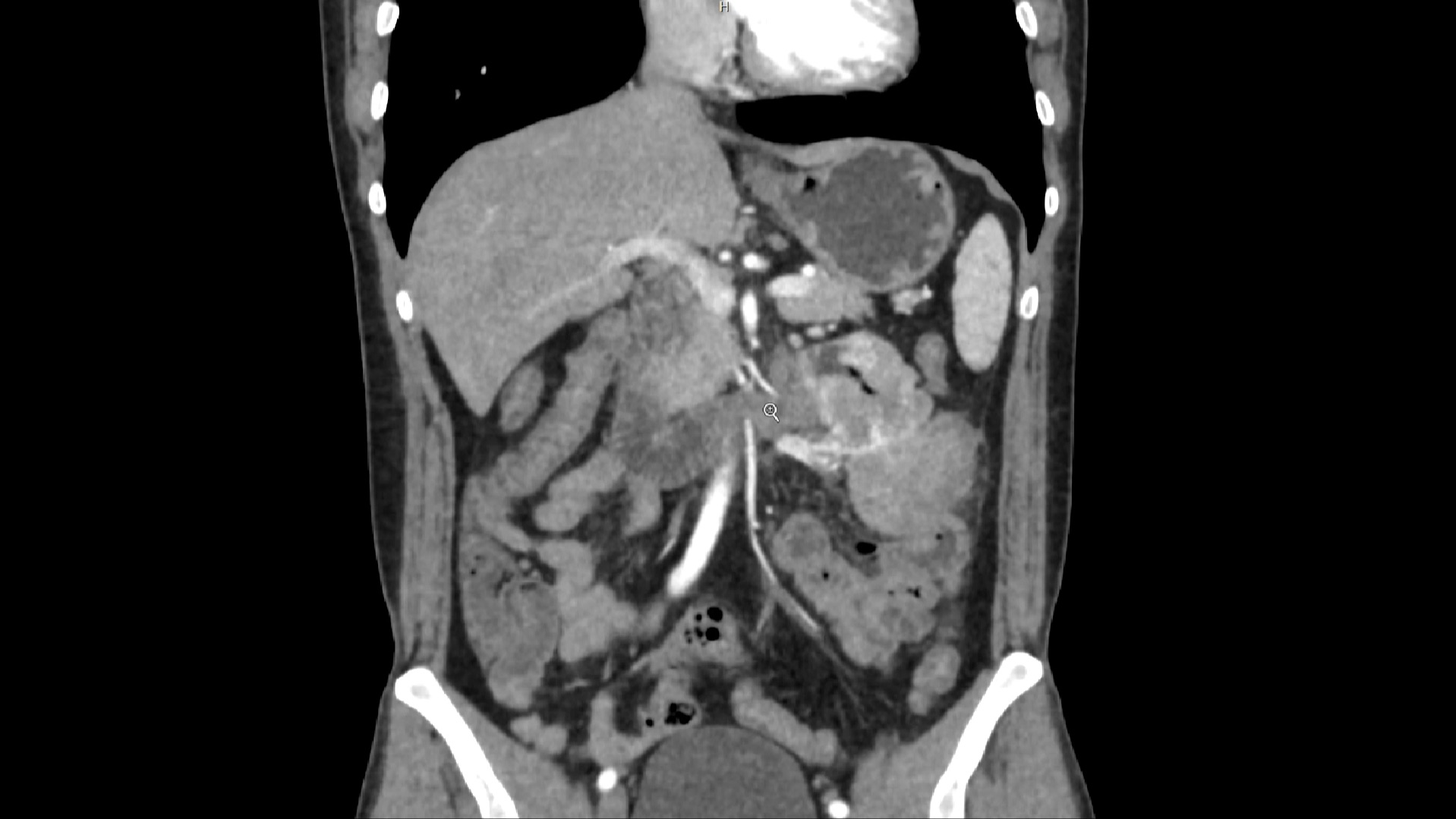 小肠间质瘤的增强CT下表现