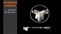 脊柱后路钉棒系统(U型)手术操作动画演示