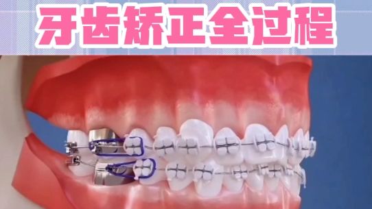 牙齿矫正全过程,想正畸的你一定要看