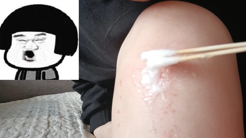 洗伤口之双氧水篇