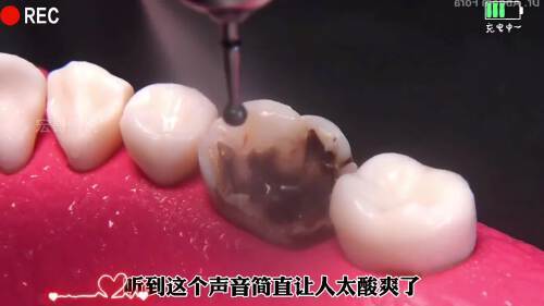 牙齿修复根管治疗全过程,奉劝大家一定要更加爱护自己的牙齿