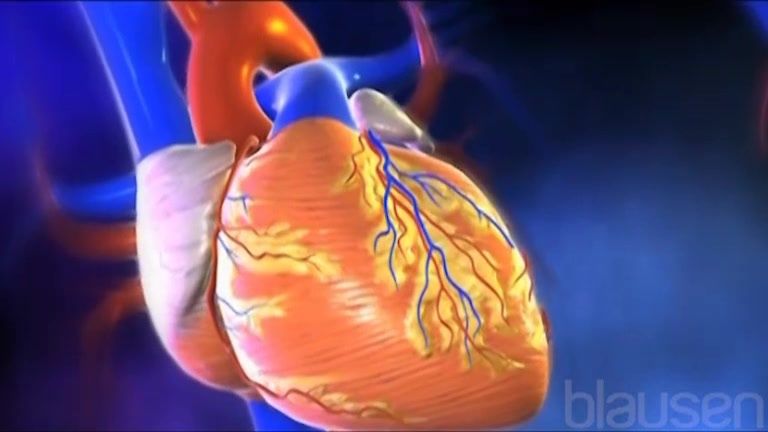 医学3D动画演示:冠状动脉粥样硬化与心肌梗死