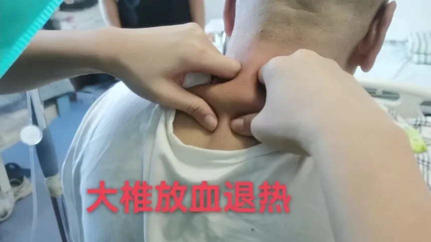 大椎放血退热方法简单,在家自己就可以完成