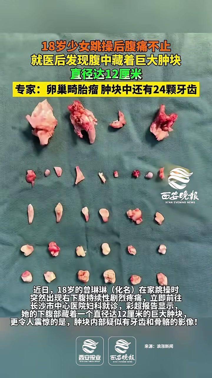 18岁少女跳操后腹痛不止,就医后发现腹中藏着巨大肿块,直径达12厘米...