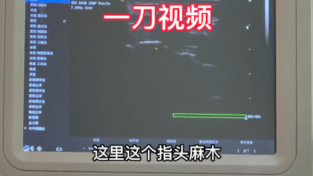 腕管综合征合并腱鞘炎微创治疗技术《一刀开鞘术》培训,随治随走、...