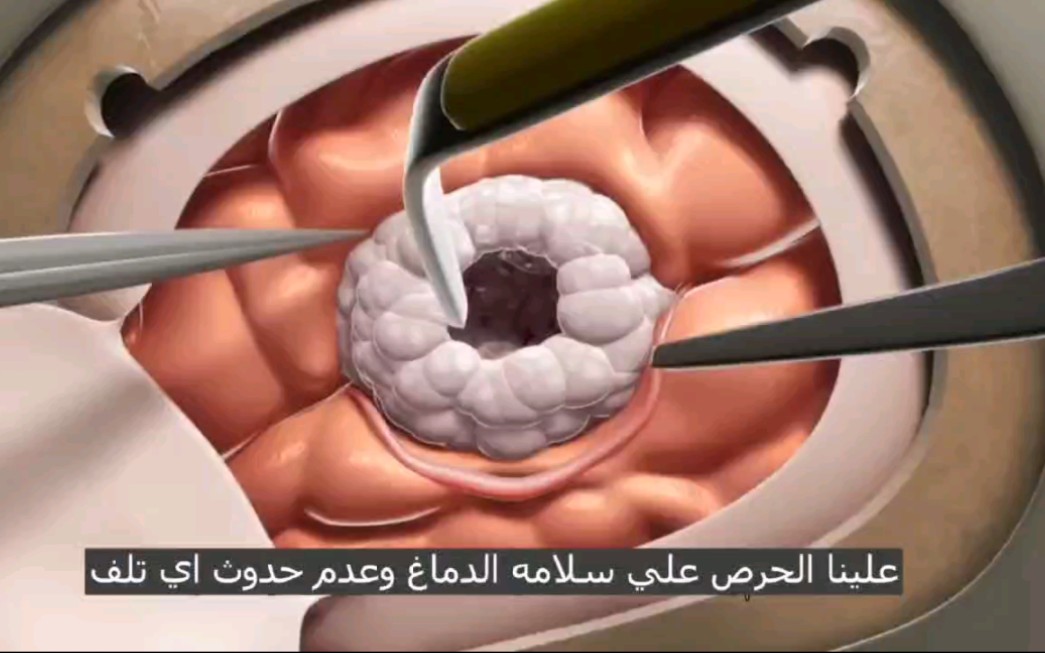 脑肿瘤切除手术过程,3D演示。