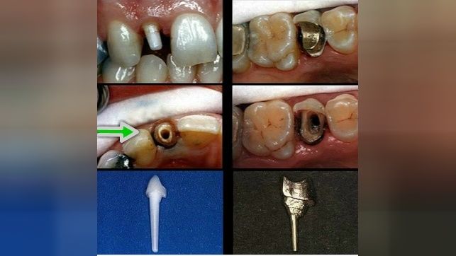 口腔修复系列教学视频——桩冠4