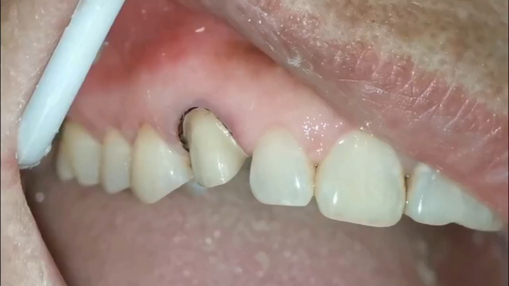 全瓷牙取模过程