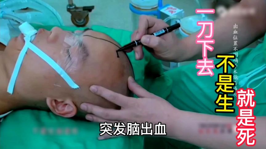 23岁男孩熬夜玩手机导致脑出血,无法确定出血位置,医生冒险开颅