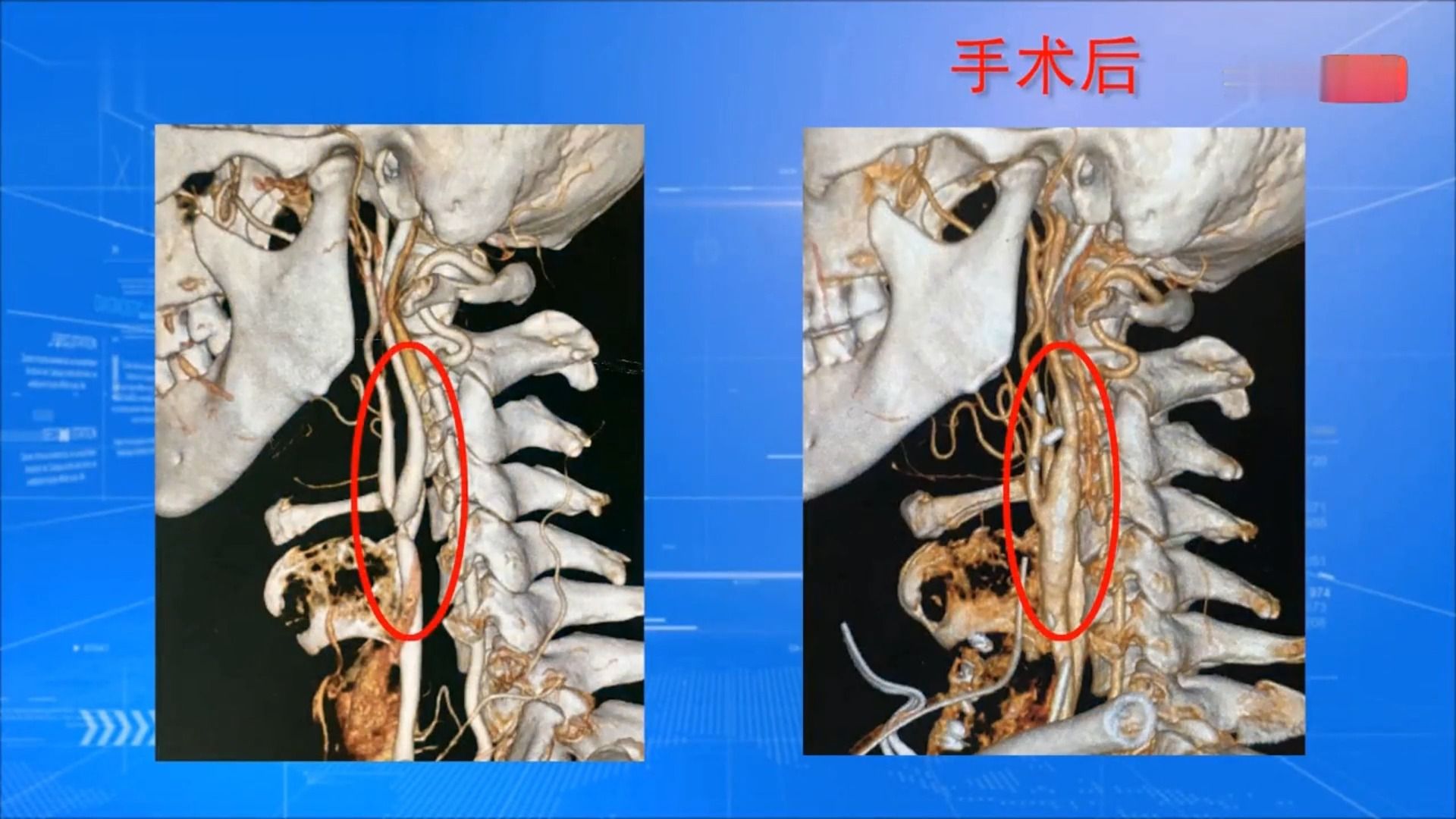 颈动脉内膜剥脱术(CEA)