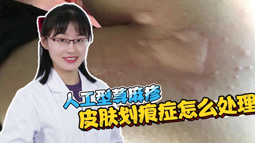 人工荨麻疹,皮肤划痕症怎么处理?