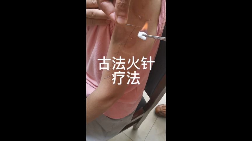 即将失传的古老中医疗法一一火针