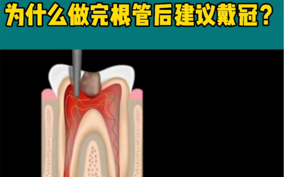 为什么根管治疗后建议戴牙冠?