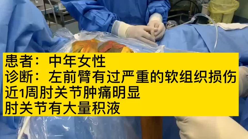 关节镜微创手术全过程【给看完的人点赞】